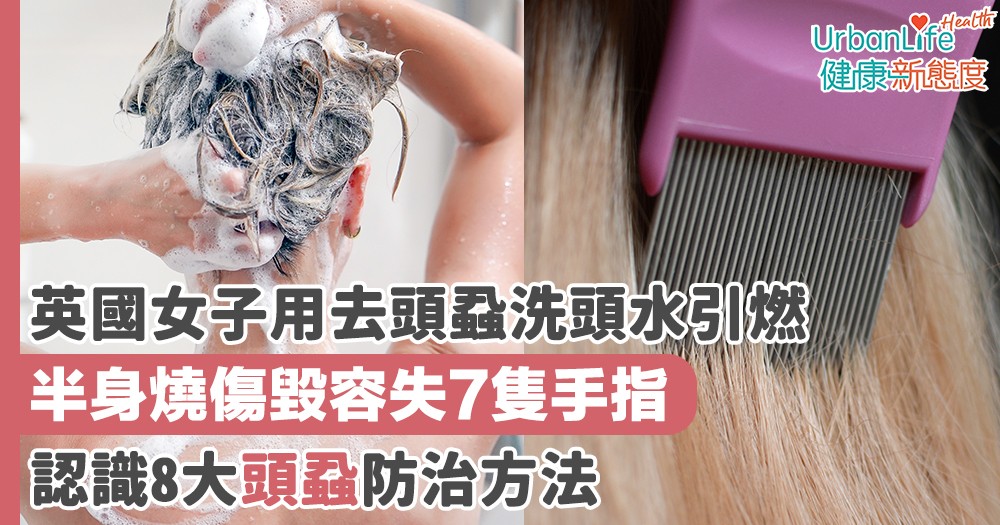 頭蝨症狀｜英國女用去頭蝨洗頭水引燃燒傷毀容 5大頭蝨防治方法